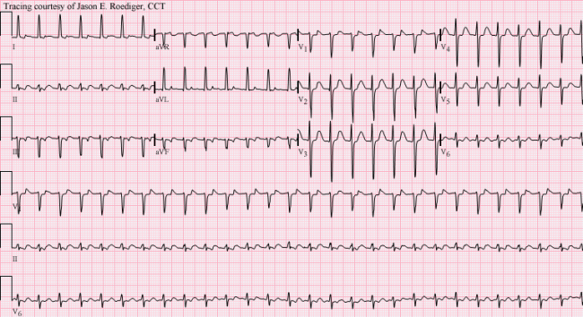 Sinus tachycardia | ECG Guru - Instructor Resources Sinus tachycardia | ECG Guru - Instructor Resources